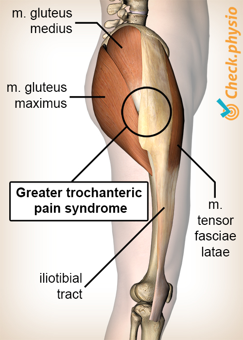 Greater Trochanter Pain Syndrome Cause Symptoms Treatment